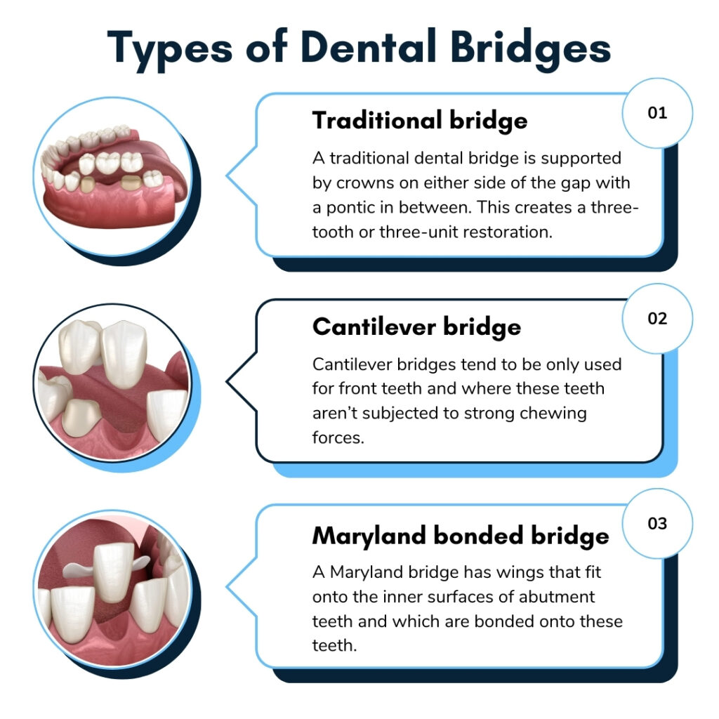 Dental Bridges in Astoria and Bayside, Queens, NY