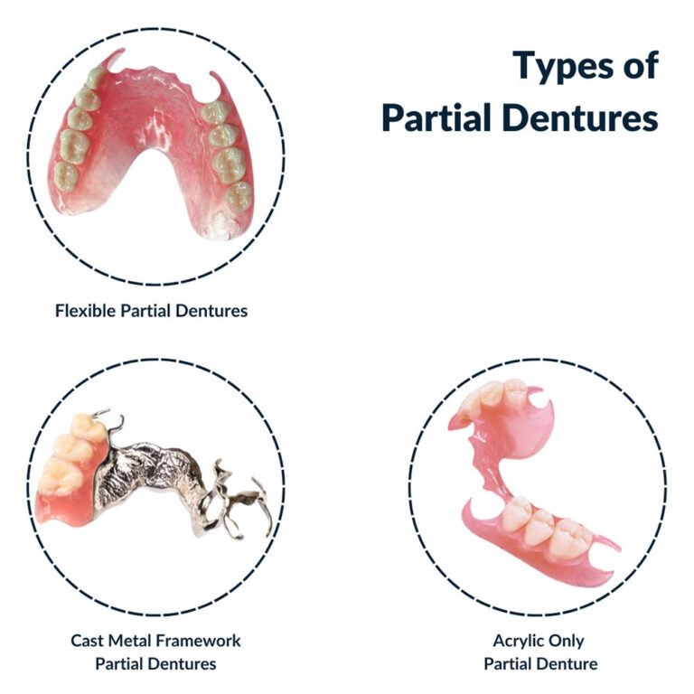 What Are the Different Types of Partial Dentures? | Precision Dental NYC